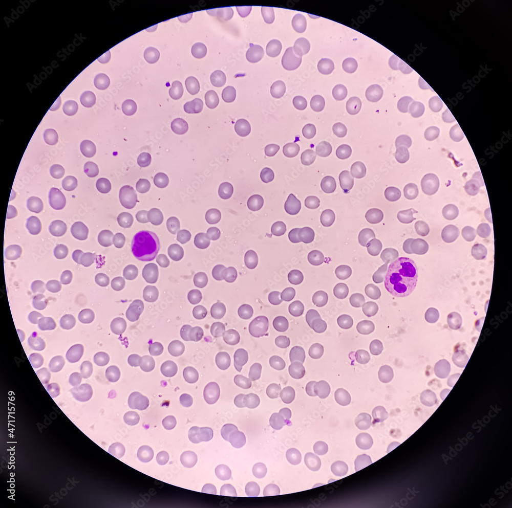 Human blood smear view in microscopy, complete blood count for ...