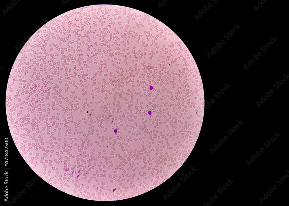 Foto de Abnormal microscopic view of hematological slide. Hemoglobin E ...