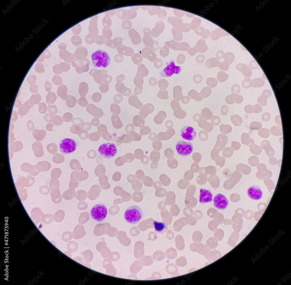 Microscopic image showing thrombocytopenia with leukocytosis, monocytes ...