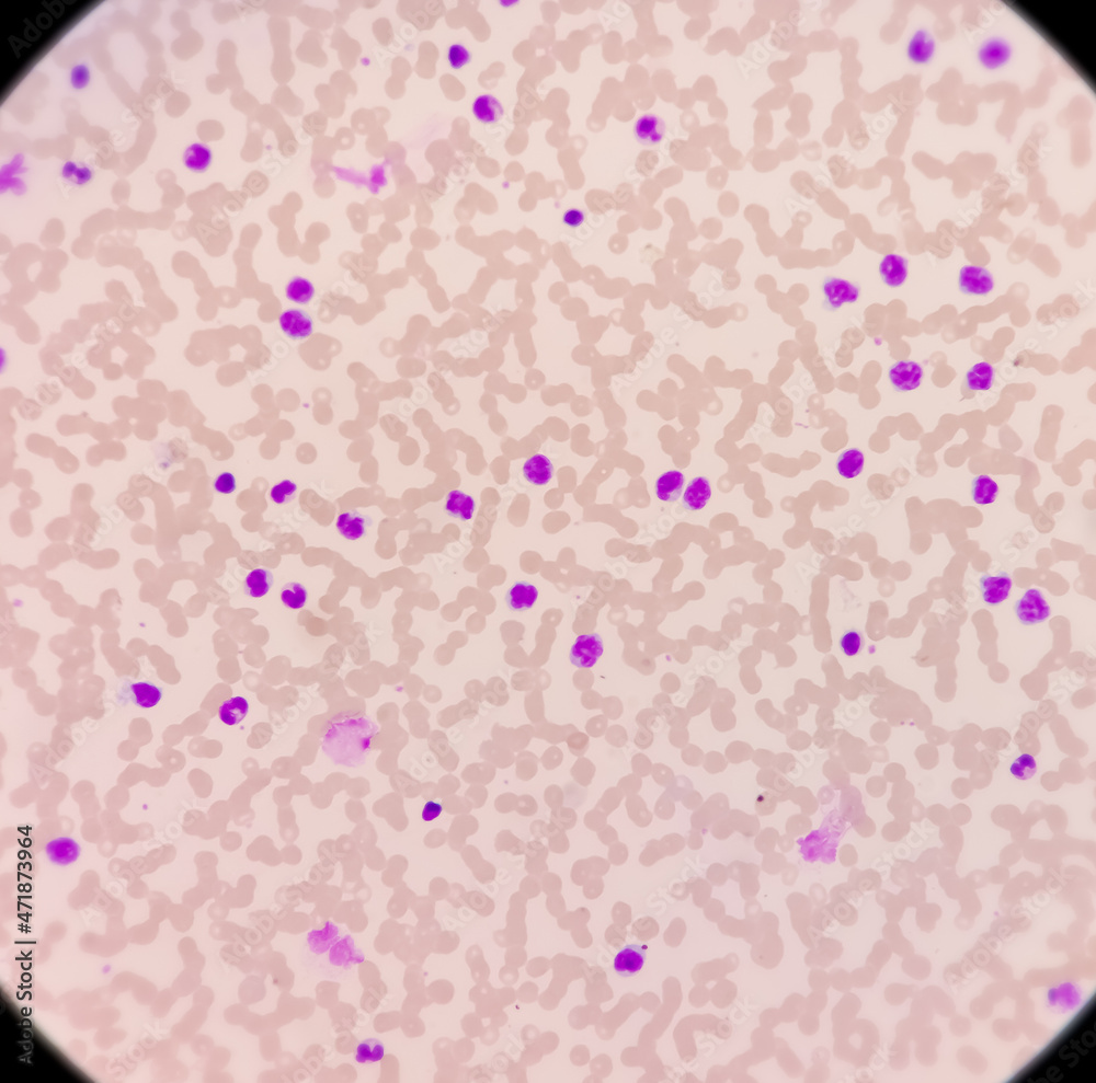 Microscopic image showing thrombocytopenia with leukocytosis, monocytes ...