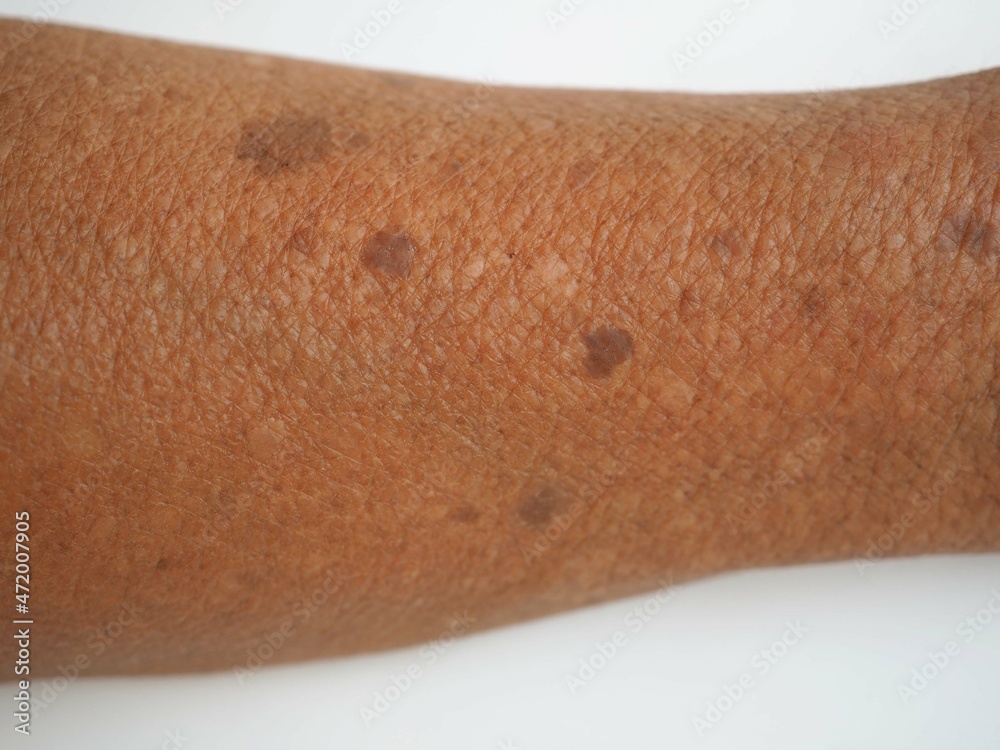 Old senior woman face and arms, melasma, freckle, aging, skin problem ...