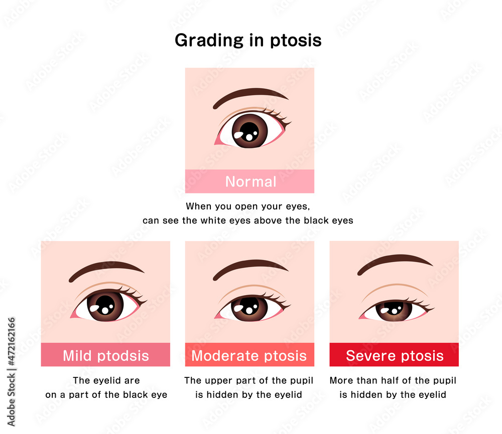 Grading in ptosis vector illustration Stock Vector | Adobe Stock
