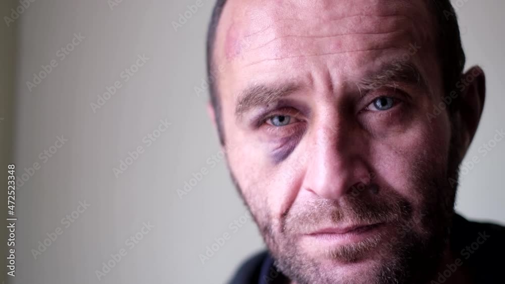 Bruise and hematoma under the eye close up. The consequences of a ...