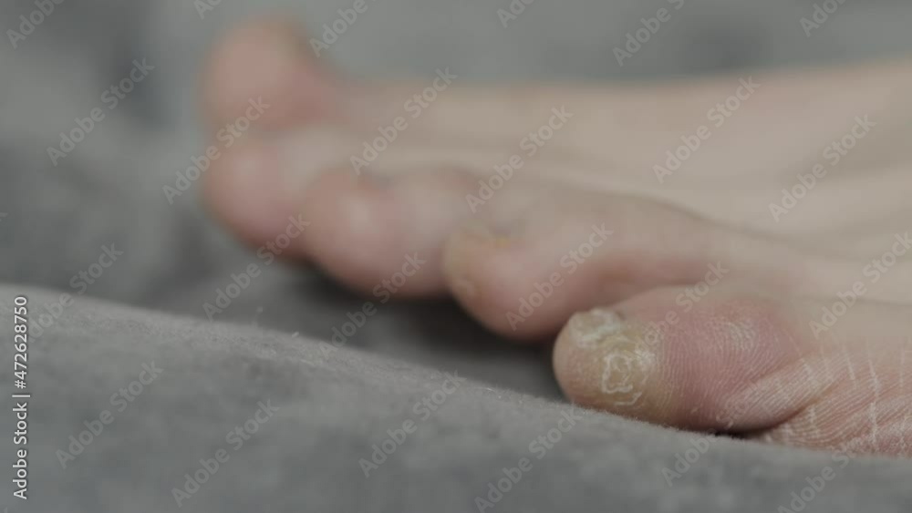 callus and dry skin on the little toe, macro. Dermatology Stock ビデオ ...