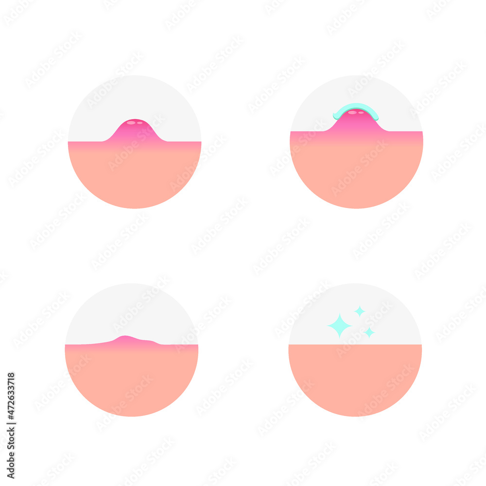 Treating inflammation. An abscess, a lump on the skin. Stages of ...