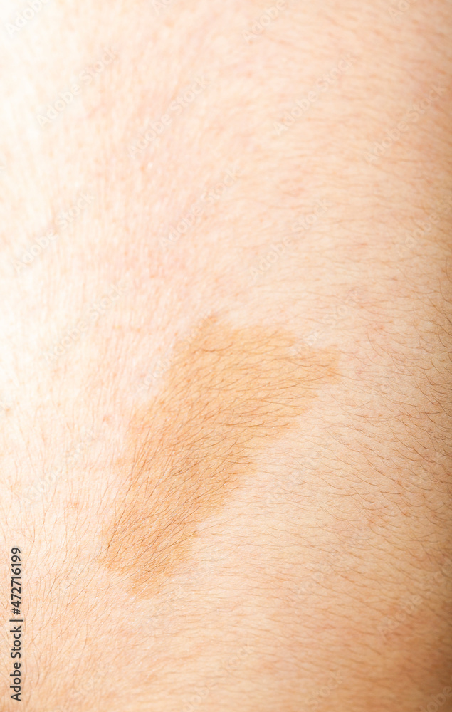 A large light brown cafe au lait spot known as birth mark on the inter ...