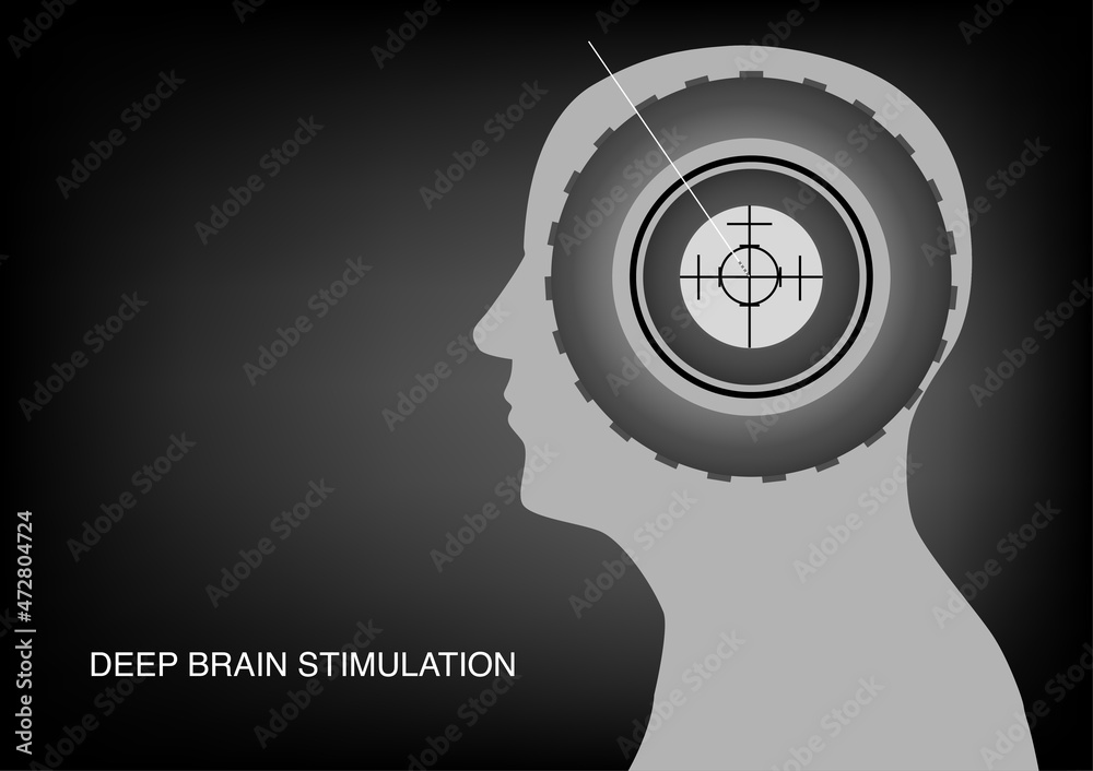 Deep brain stimulation surgery for Parkinson's disease. Placement of ...
