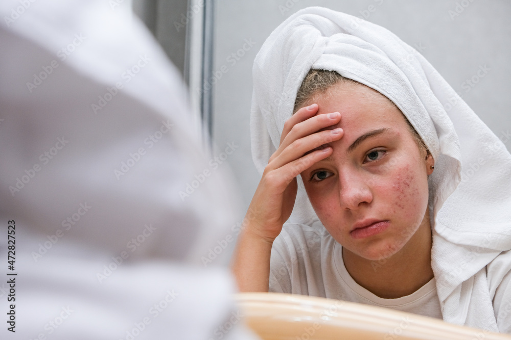 Acne. A sad teenage girl. Problematic skin in adolescents. Stock Photo ...