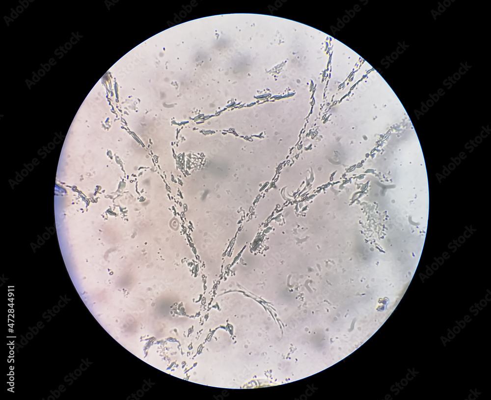 Microscopic view of dermatophytes. fungus test. 40X. Diagnosis for ...