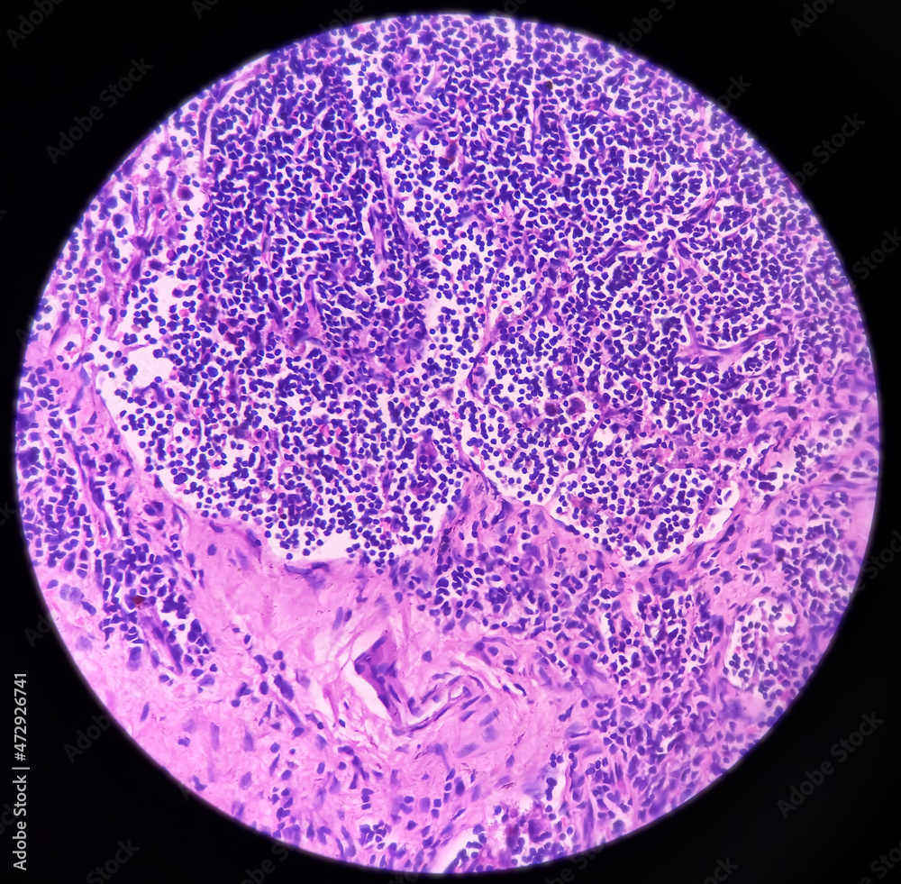 Lymph angioma, Photomicrograph of lymphangioma(cystic hygroma) or ...