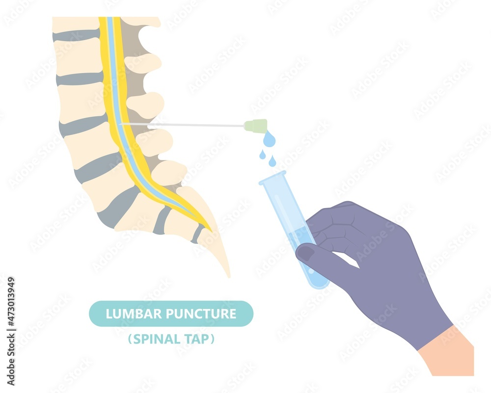 Lumbar puncture for infalmmation Bleeding cancer brain inject ...