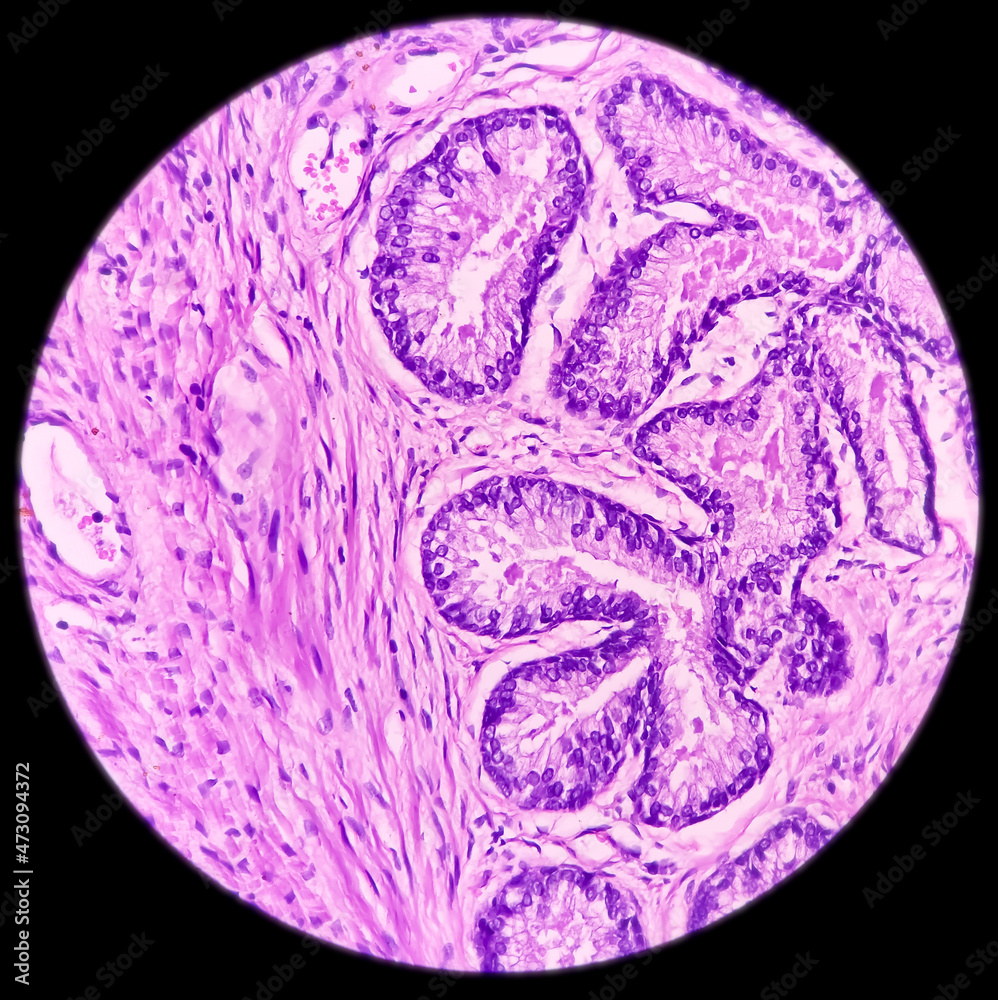 Benign prostatic hyperplasia. Micrograph show proliferation of fibro ...
