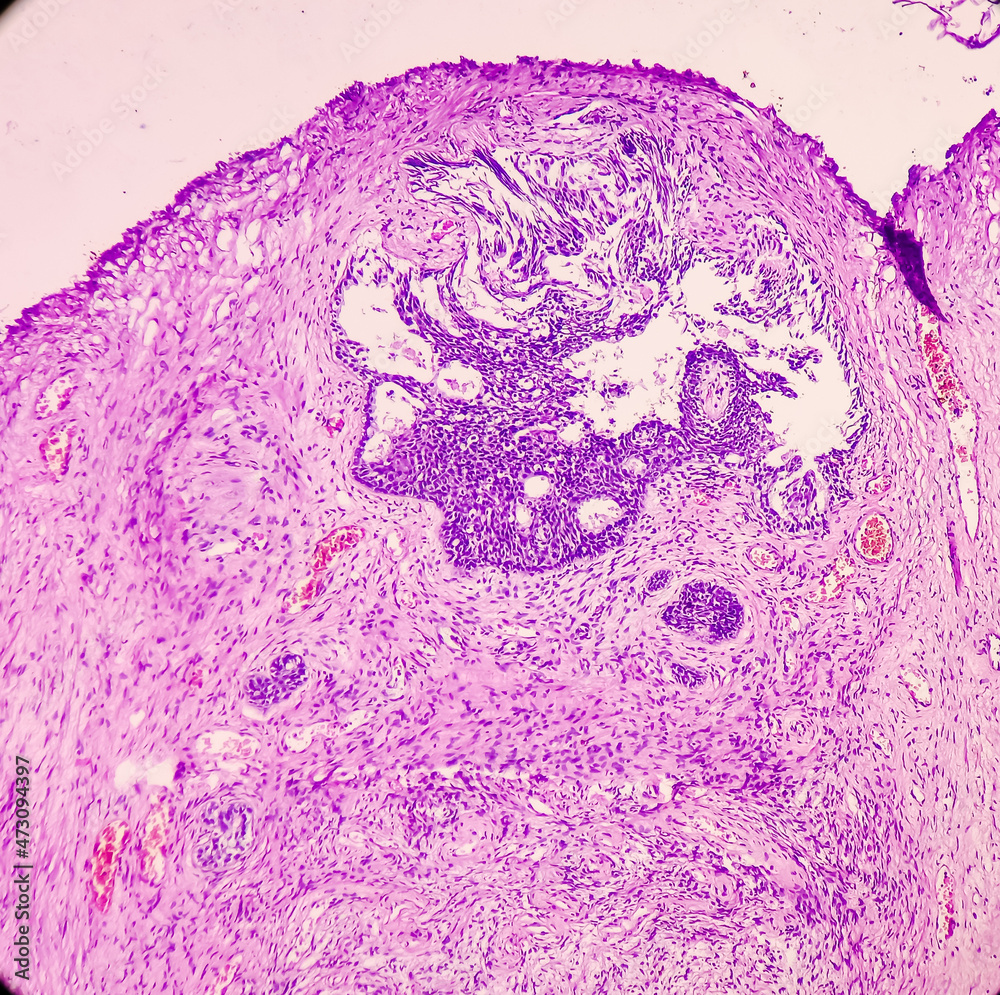 Nodular prostatic hyperplasia. Micrograph show proliferation of fibro ...