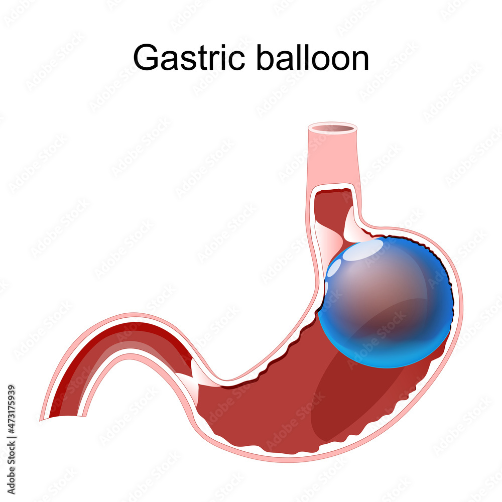 Gastric balloon. Intragastric Balloon Inside a Stomach. Stock Vector ...