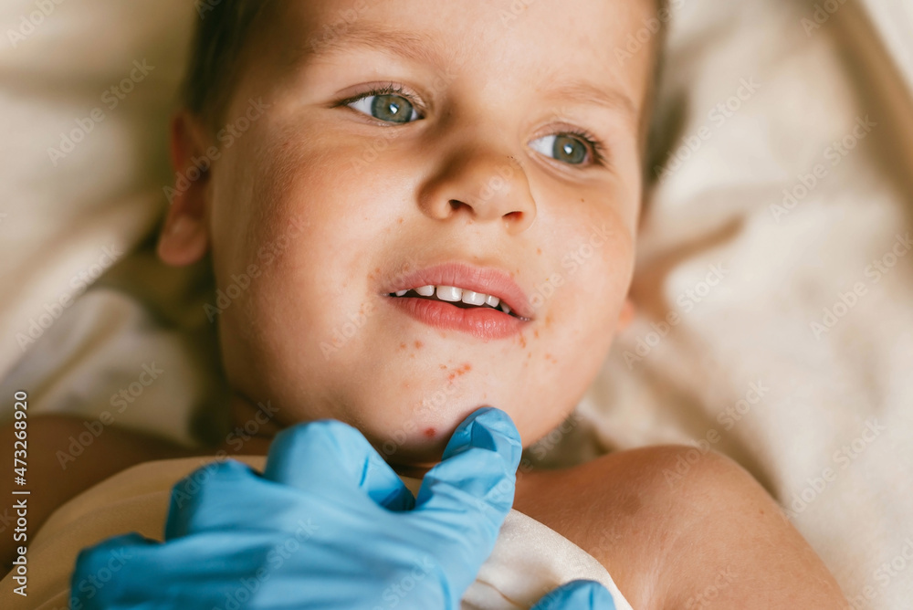 Rash of enterovirus infection picornavirus families on the face of a 3 ...