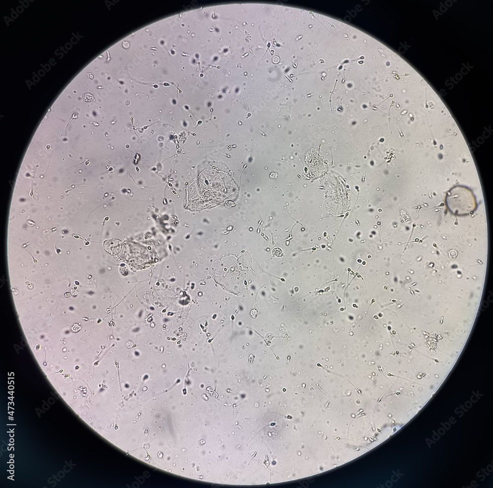 Semen analysis, sperm analysis on microscopic examination ...