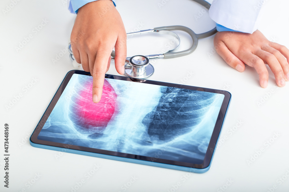 Doctor or scientist points to the results of lung check up from x-ray ...