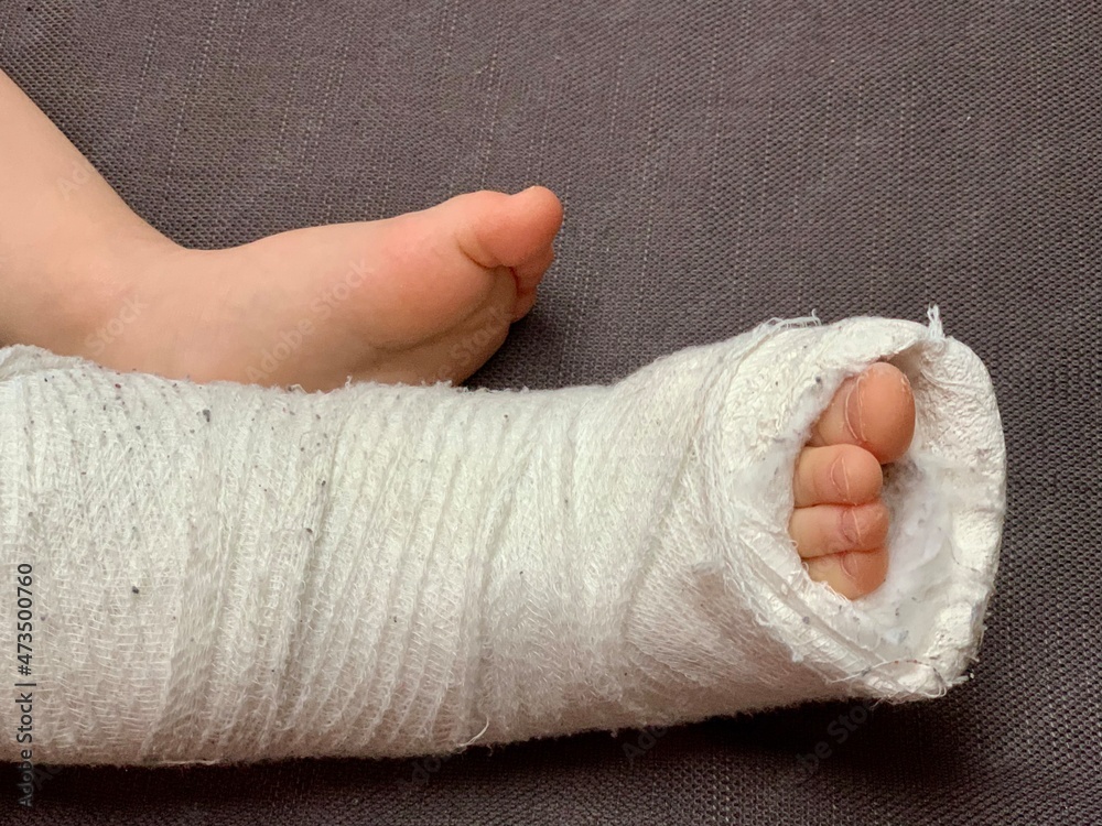 baby broken leg in a cast, childhood trauma, bone fracture, injury ...