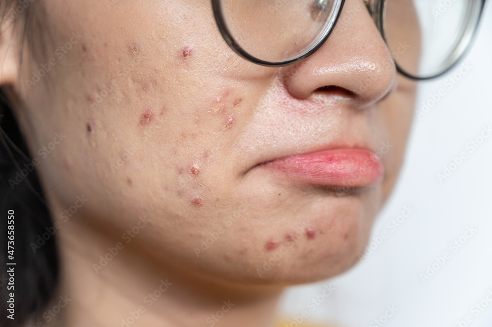 Close up of worried Asian woman having acne inflamed on her face ...