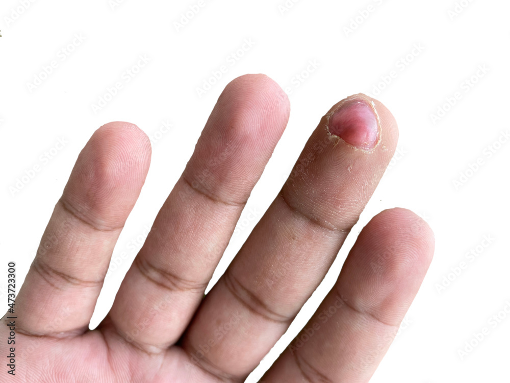 Scraped and peeled finger skin on isolated white background- Skin ...