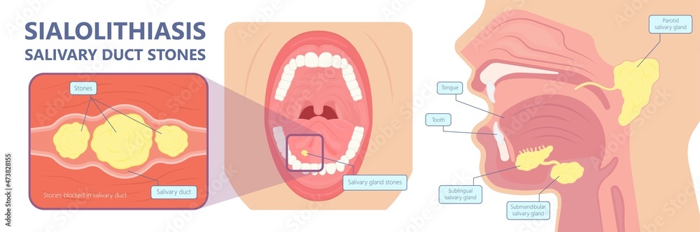 Stockvector Parotid gland Sialadenitis bacterial infection ...