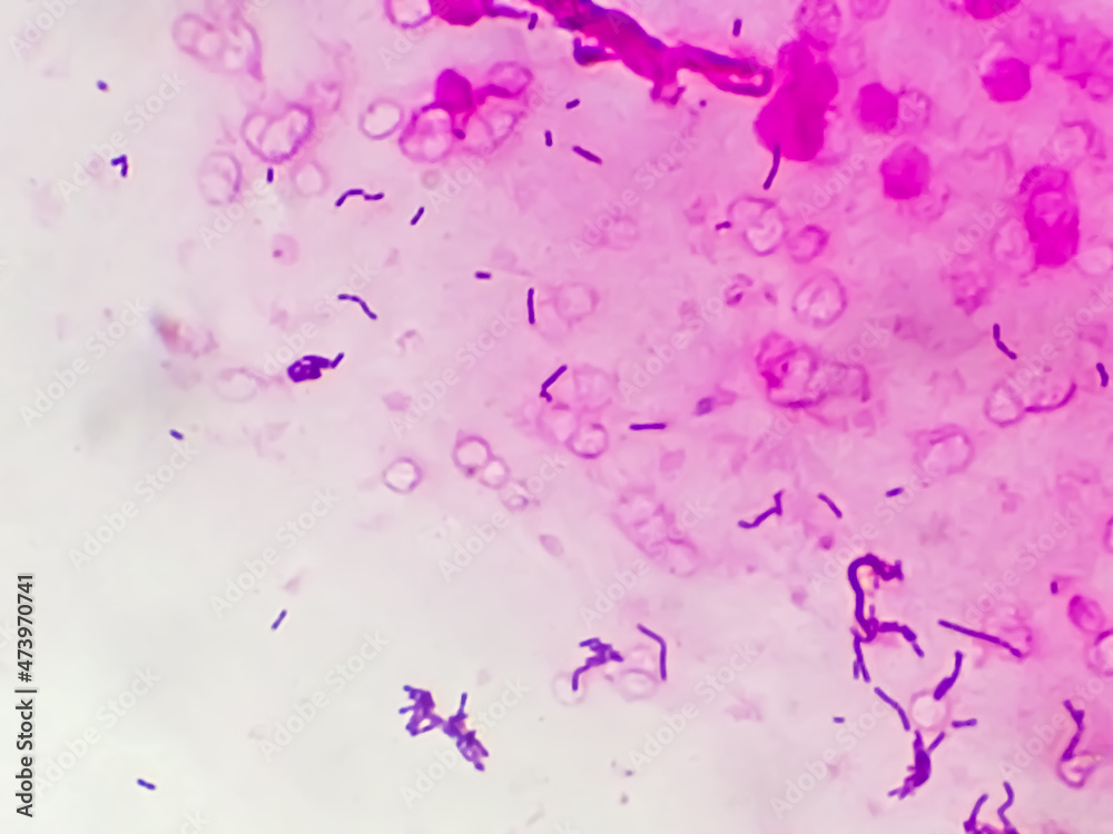 Gram positive cocci in cluster of Staphylococcus spp. under 100X ...
