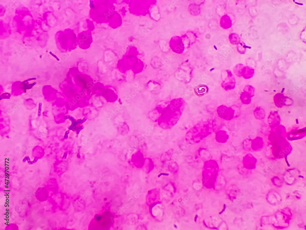 Pus gram stained microscopic 100x zooming show few pus cells and ...