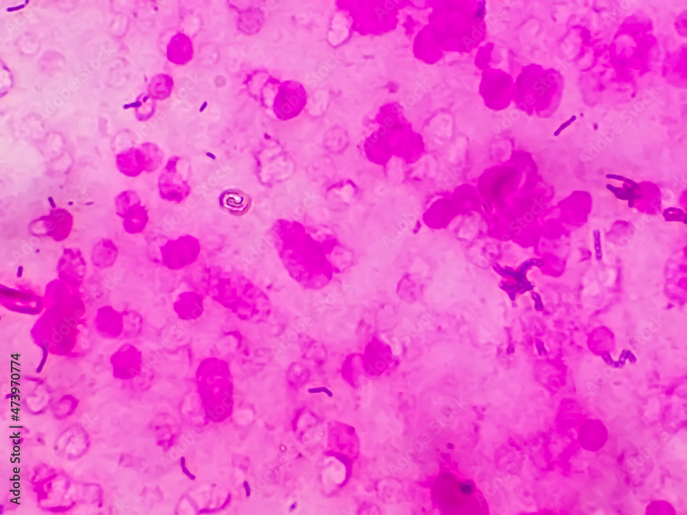 Gram positive cocci in cluster of Staphylococcus spp. under 100X ...
