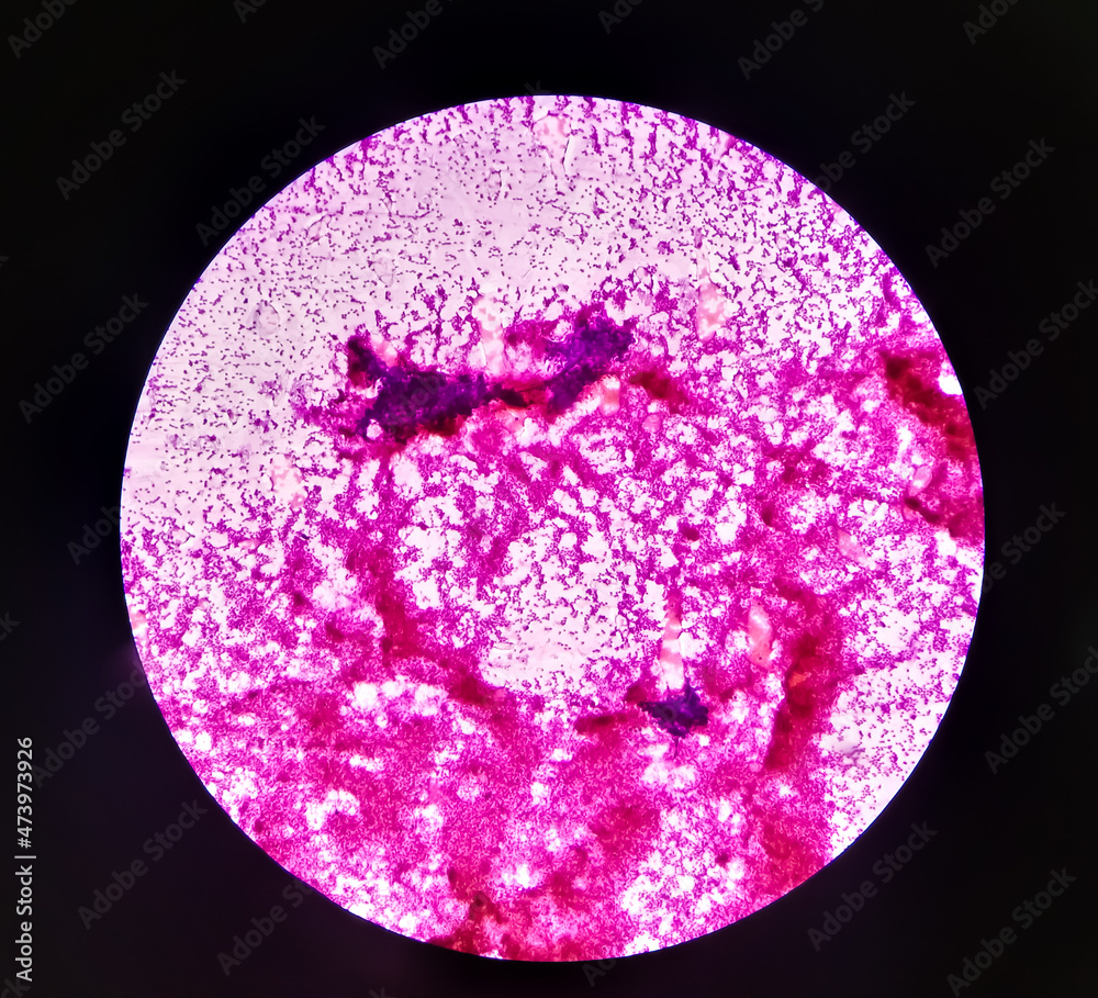 Pleomorphic adenoma. Left parotid swelling (FNA) hematoxylin and eosin ...