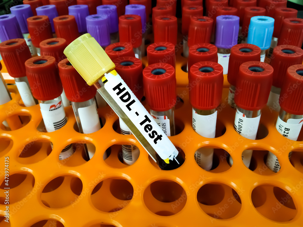 Blood sample tube for HDL cholesterol test Stock Photo | Adobe Stock