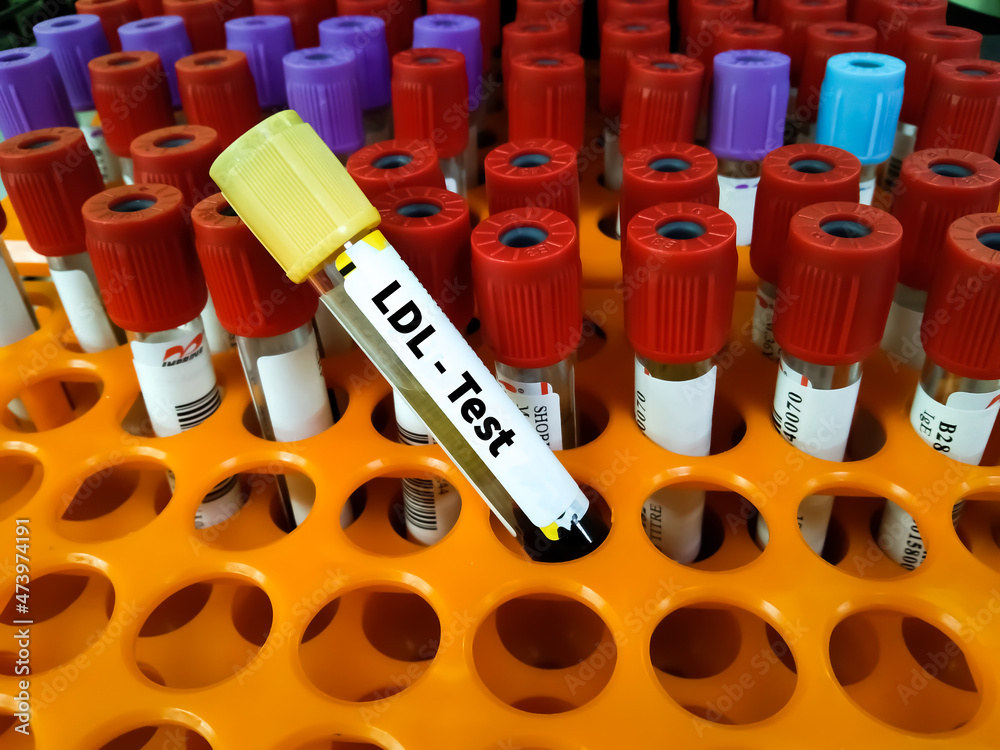 Blood sample tube for LDL (low density of lipoprotein) Cholesterol test ...
