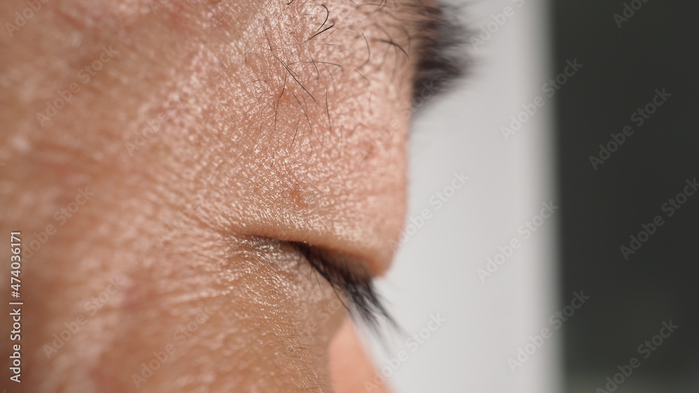 Wart on face. Macro shot of wart near eye. Papilloma on skin around eye ...