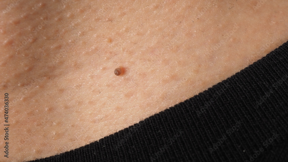 Wart on face. Macro shot of wart near eye. Papilloma on skin around eye ...