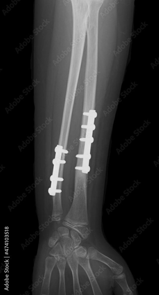 x ray of broken hand ,internal fixation plate and screw on ulna and ...