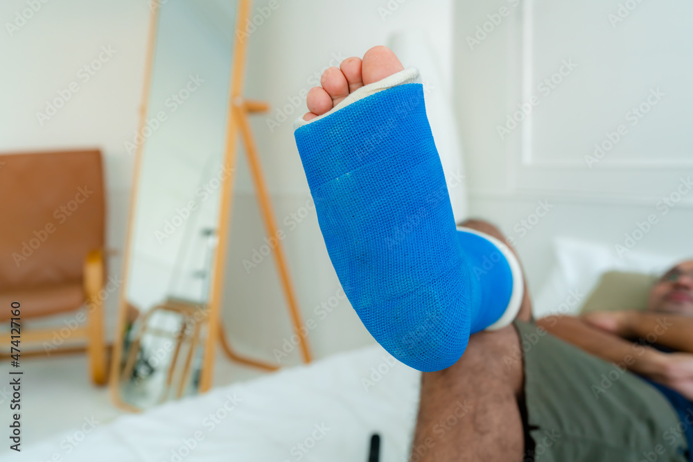 Broken Ankle Cast Blue