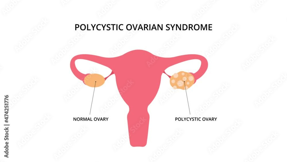 Polycystic ovarian syndrome 2D animation. Uterus, infertility ...