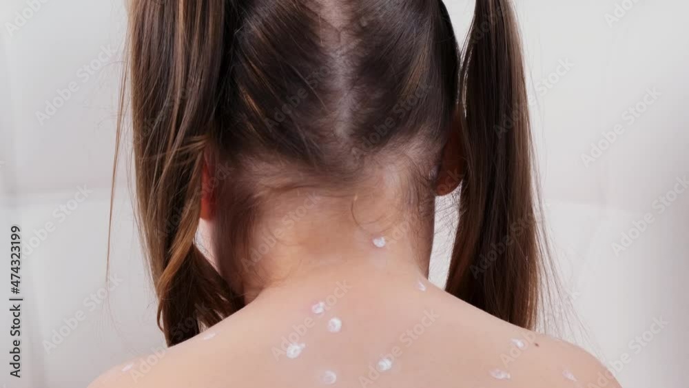 back girl with chickenpox, antiseptic cream applied to the rash. Rash ...
