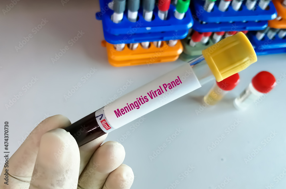 Blood sample for Meningitis viral panel test with laboratory background ...