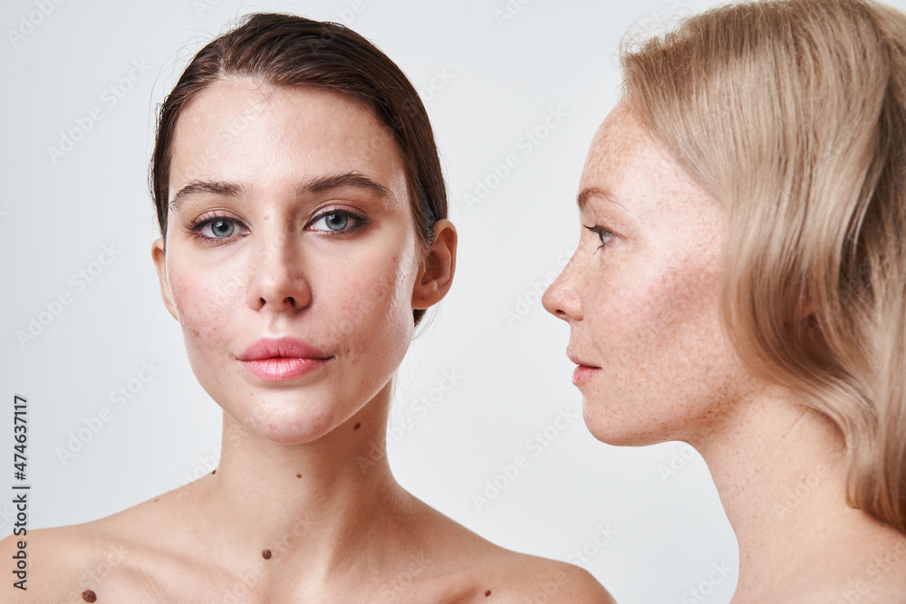 Woman looking at brunette girl with acne skin while posing at studio ...