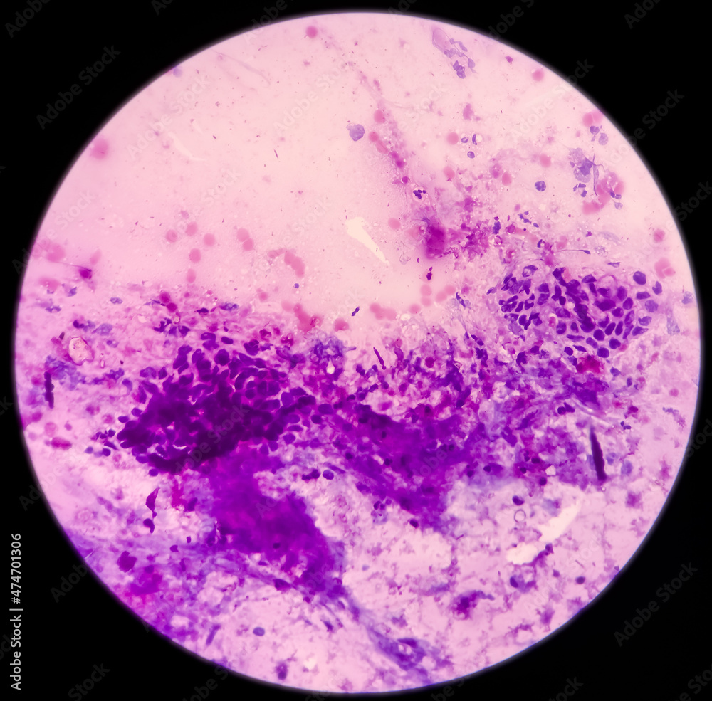 Foto de High grade squamous intraepithelial lesion(HSIL ...