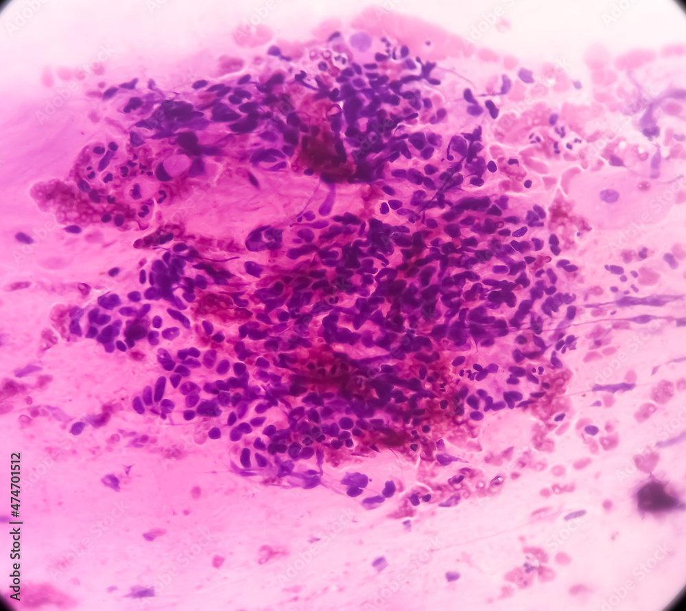 Foto De High Grade Squamous Intraepithelial Lesion Hsil
