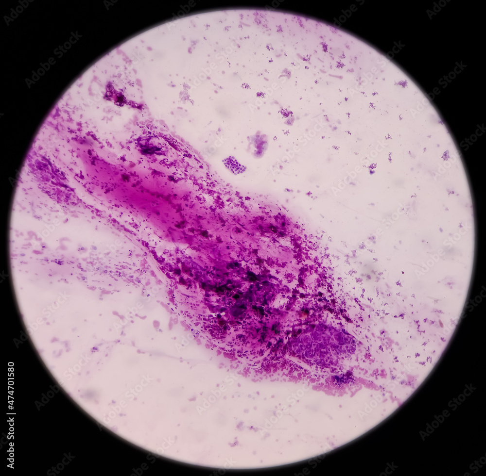 Plakat High grade squamous intraepithelial lesion(HSIL ...