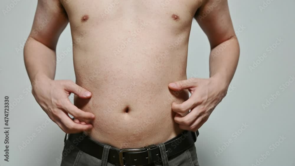 Dermatitis viral disease of young adult asian body standing scratching ...