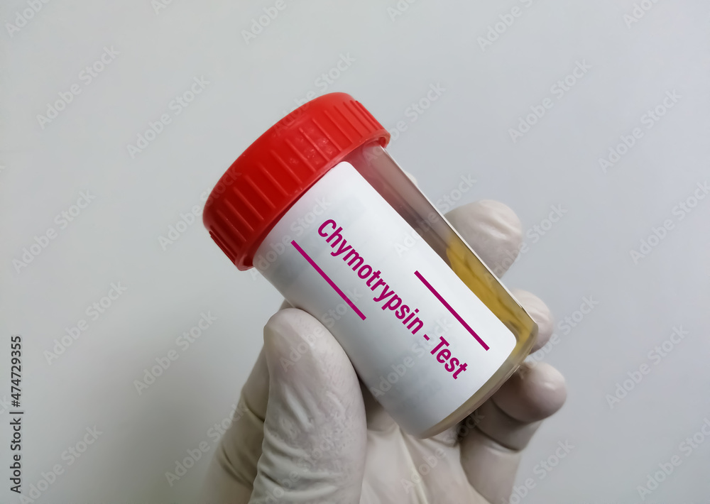Researcher hold sample in container for Stool Chymotrypsin test with ...