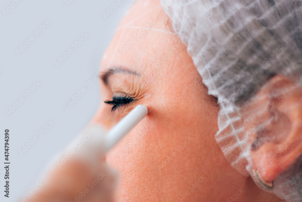 White pencil markings on the patient's face for botox injection in the ...