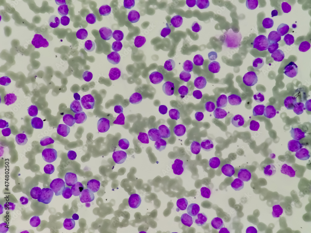 Photomicrograph of Acute Myeloblastic Leukemia (AML), a cancer of white ...