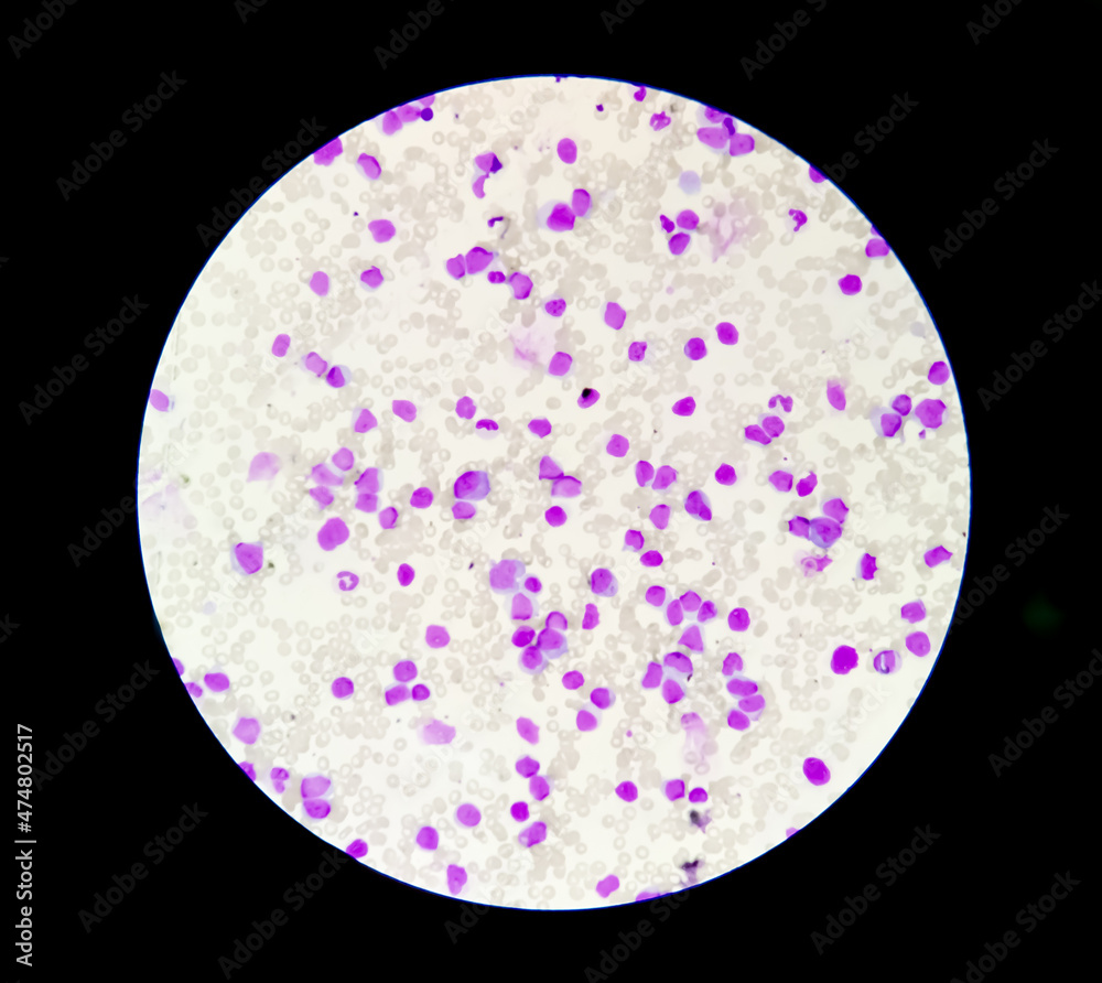 Acute myeloid leukemia (AML) is a type of blood cancer. Microscopic ...