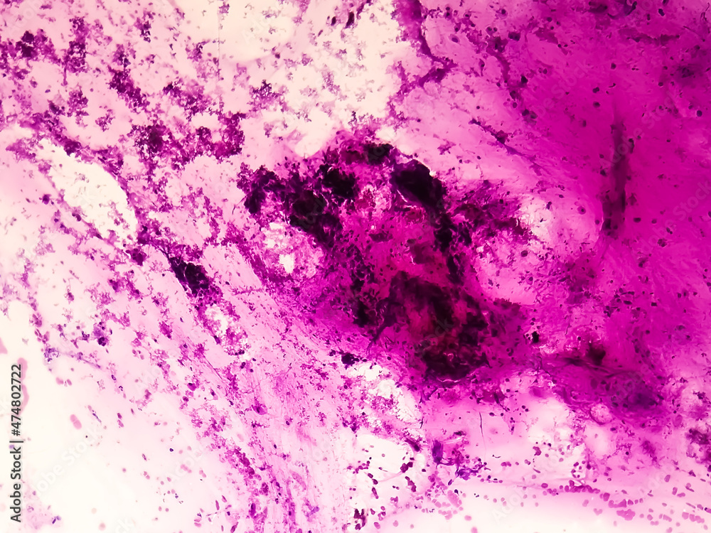 Pancreatic mass(CT Guided FNA): Positive malignant cell, adenocarcinoma ...
