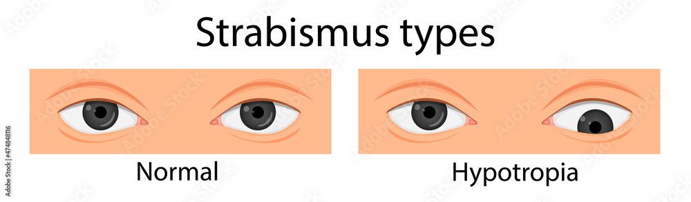 Poster Types of strabismus – Wall Art | UkPosters