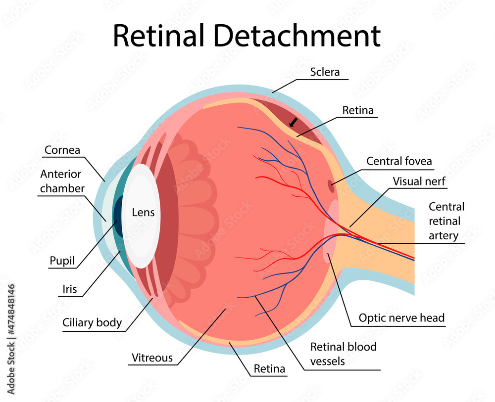 Stockvector Retinal detachment vector diagram, anatomical diagram ...